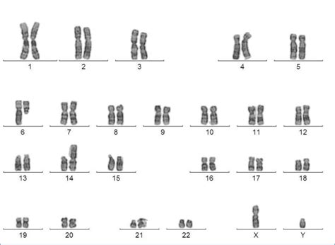 Reciprocal Translocation Karyotype Analysis 46xyrcp614