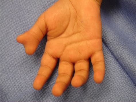 Bifid Thumb Duplicate Thumb Supernumerary Thumb Hand Surgery Resource