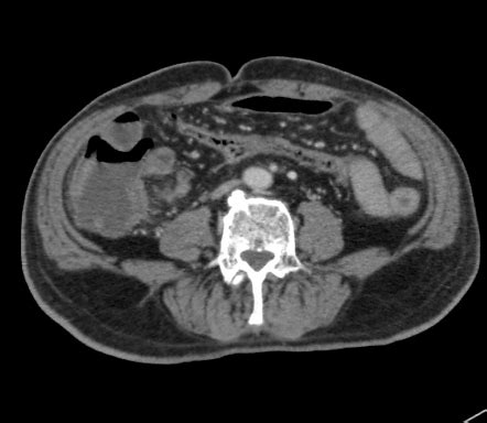 Perforated Appendix Radiology Case Radiopaedia Org