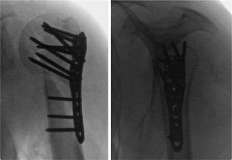 Intraoperative Radiographs Of Open Reduction And Internal Fixation