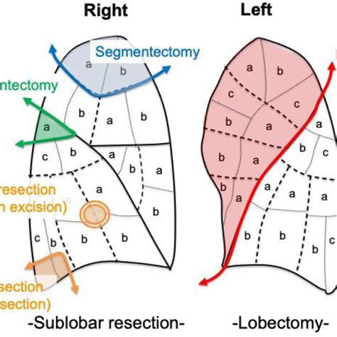 Thoracoscopic Surgical Strategy For A Small Sized Lung Tumor In Our Download Scientific Diagram
