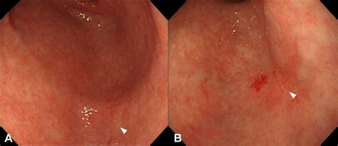 Endoscopic Causes And Characteristics Of Missed Gastric Cancers After Endoscopic Submucosal