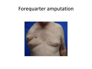 Amputation And Rehabilitation Pptx