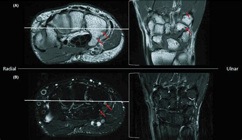 Mri Showing T1 Hypointense And T2 Hyperintense Arrows 6‐mm Lesion In