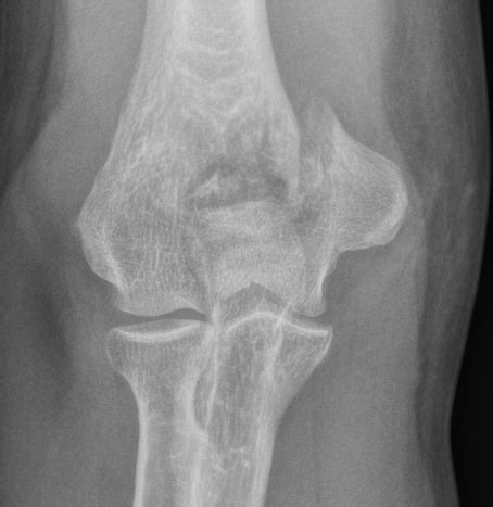 Intra Articular Distal Humerus Fractures The Bone School