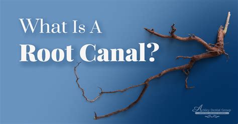 Root Canal Therapy Ackley Dental Group
