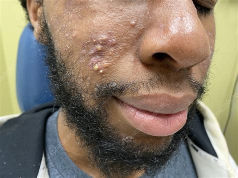 Dissecting Cellulitis Stock Image C060 4133 Science Photo Library