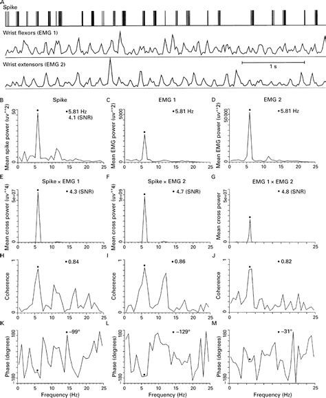 Thalamic Neuronal Activity Correlated With Essential Tremor Journal Of Neurology Neurosurgery