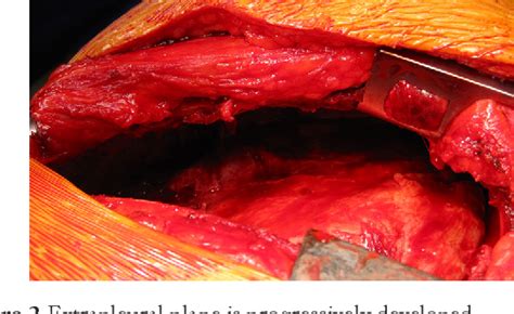 Figure 4 From Pleurectomydecortication For Malignant Pleural