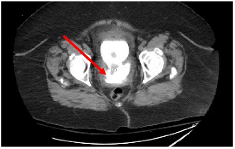 Ct Cystogram Demonstrating Extravasation Of Contrast From The Urinary Download Scientific