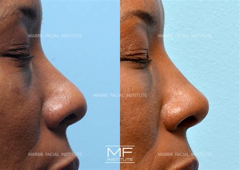 4 Ways To Make Your Nose Appear Smaller With Filler Mabrie Facial