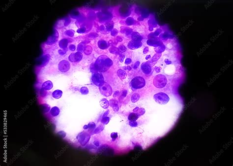 Cytological Study Of Intra Abdominal Mass Spindle Cell Sarcoma