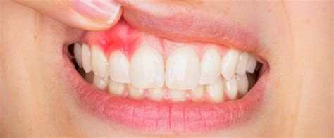 ¿qué Es La Gingivitis