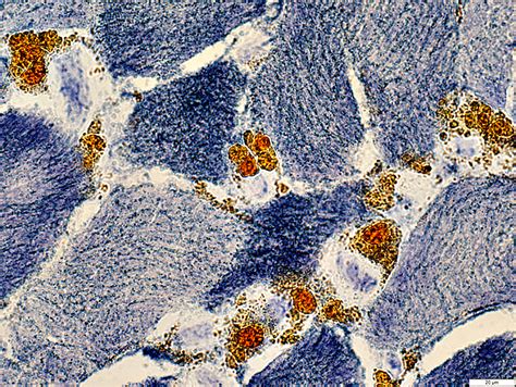 Hemosiderin Staining Cream At Grace Carmichael Blog