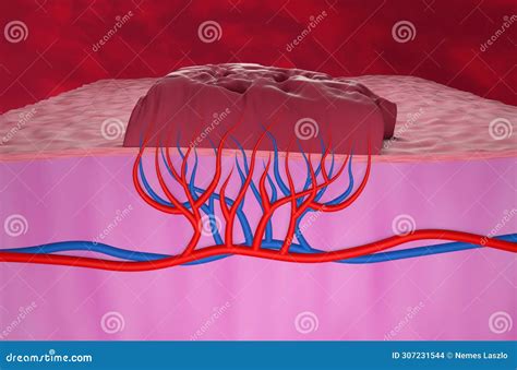 Hemangiomas Vector Illustration 351779266