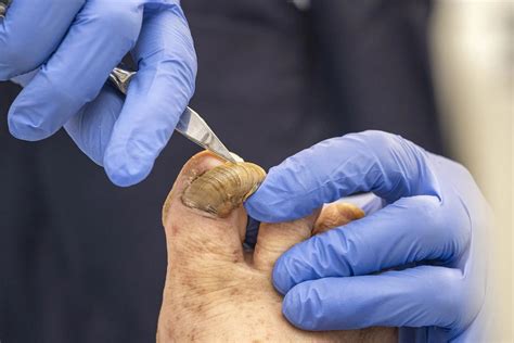 40 Facts About Onychogryphosis