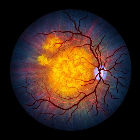 Geographic Atrophy Lesion In A Human Retina