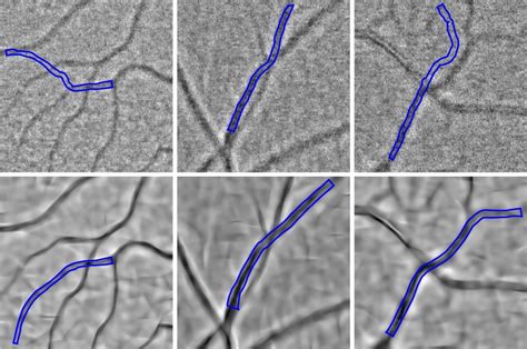 Vessel Tracking On Retinal Images From Up To Down The Original