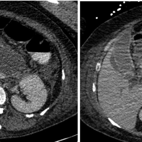 Pdf Timing Of Laparoscopic Cholecystectomy In Elderly Patients With