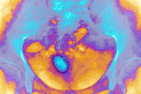 Vesical Calculus X Ray Stock Image C0380144 Science Photo Library