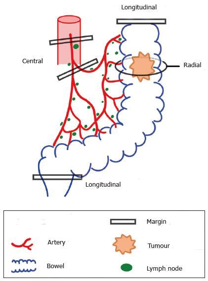 Colon Cancer With Lymph Node Metastasis Cancerwalls