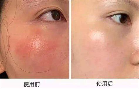 晒伤对比图的搜索结果 百度图片搜索