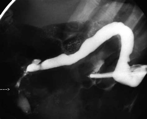 Contrast Injected Through Proximal Colostomy Showing Tight Stricture In