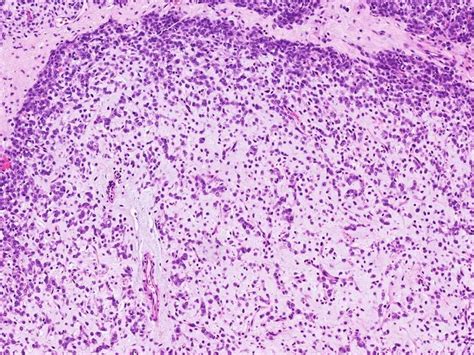 Myxoid Liposarcoma Microscopic