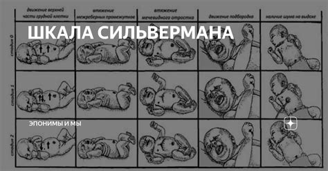 ШКАЛА СИЛЬВЕРМАНА Эпонимы и Мы Дзен
