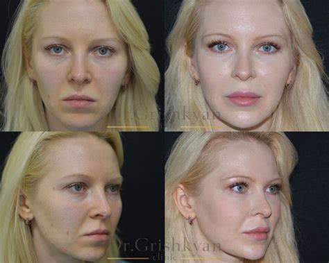 Липофилинг лица До и После Лицо Тонкие губы Брови