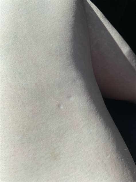 What Are These Indents On My Leg I Cannot Find Any Info Online About These Specifically They