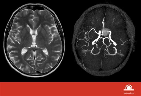 Mra Vs Mri Brain Aneurysm Foundation