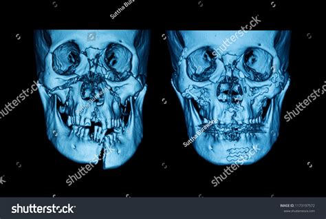 Ct Scan Facial Bone Fractures Front Foto Stock 1173197572 Shutterstock