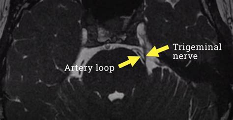 Trigeminal Neuralgia With Dr Mian Carepoint Neurosurgery And Spine