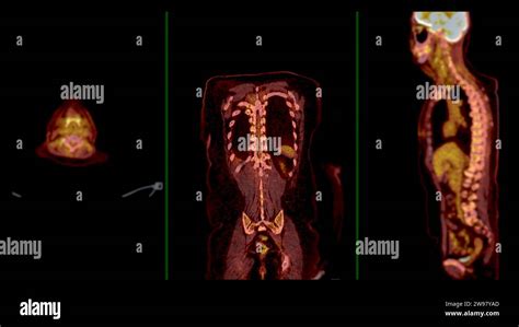PET CT Scan Fusion Image It Provides Detailed Images By Merging Metabolic Activity From PET With