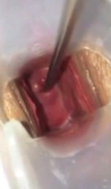 Asian Girl Cervix Insertion Attempt ThisVid Com