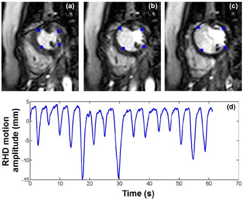 Creation Of The Respiratory And The Cardiac Motion Model Example Of