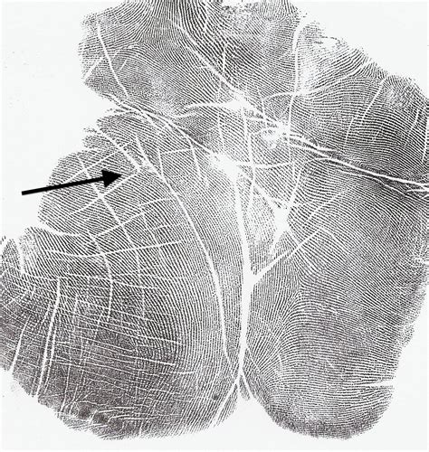 What Broken Life Lines Represent American Academy Of Hand Analysis