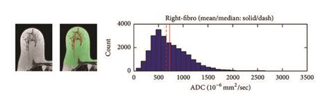 the t1wi segmented fibroglandular tissue and histogram of adc values