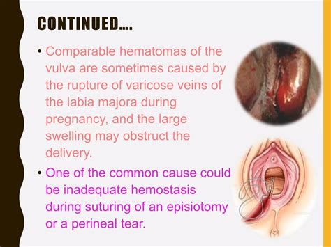 Genital Tract Injuries1 Pptx