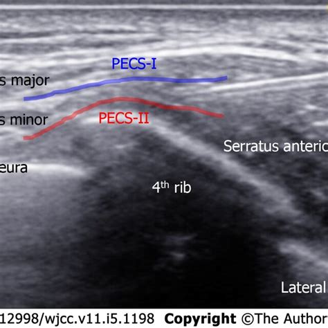 Ultrasonography Of Intercostobrachial Nerve Block Download Scientific Diagram