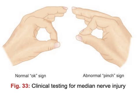 Clinical Testing For Median Nerve Injury Rnotesmedical