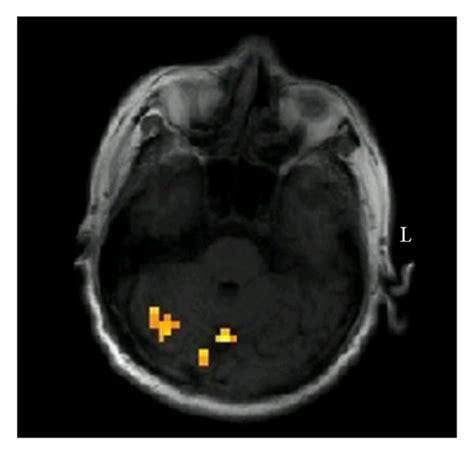 Longitudinal Observation Of Brain Activation In Case 3 During The