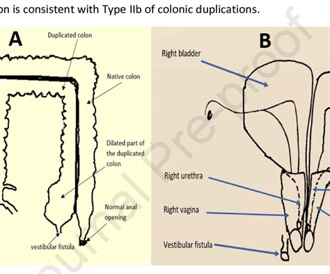 schematic demonstration of colon duplication a and genitourinary