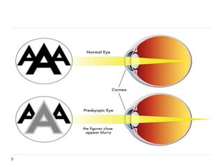 Defects Of Eye PPT