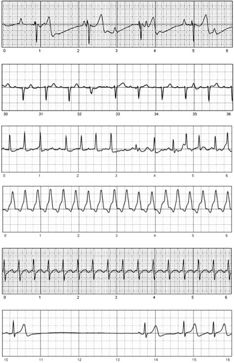 1st Panel 2nd Degree Atrio Ventricular AV Block 2nd Panel