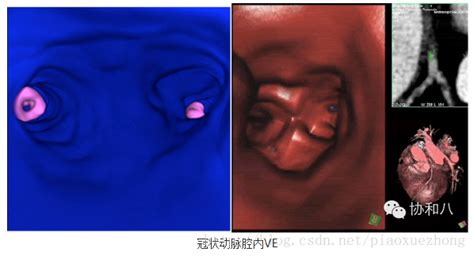 ct三维重建及三维可视化资料：opengl vtk pcl点云库 ct图像生成为3d点云 csdn博客