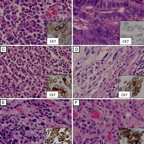 Pdf Synchronous Gastric And Sigmoid Colon Cancer Presenting Lymph