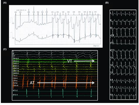 a a 24 hour holter ecg recording almost all of his tachycardia