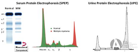 Multiple Myeloma